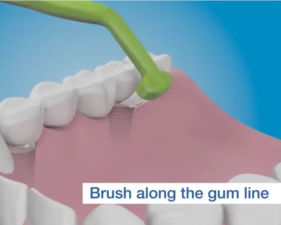 Don't get Dental Implants without reading this! 🤯