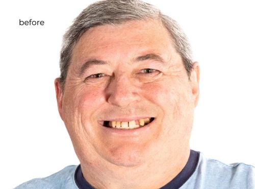 24 Hour Dental Implants in Chicago - Nuvia Dental Implant Center