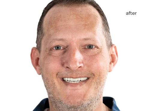24 Hour Dental Implants in Chicago - Nuvia Dental Implant Center