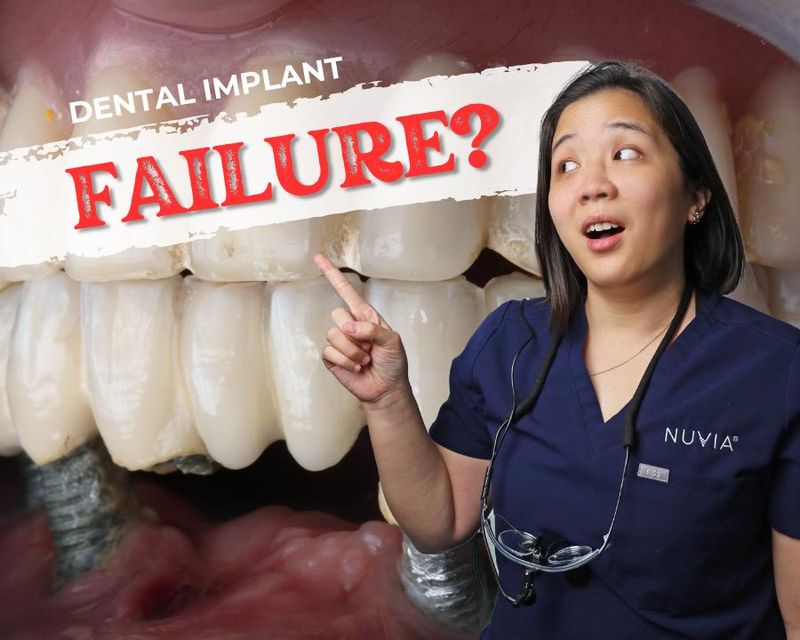 Dental Implant Failure Signs and Ways to Minimize Your Risk