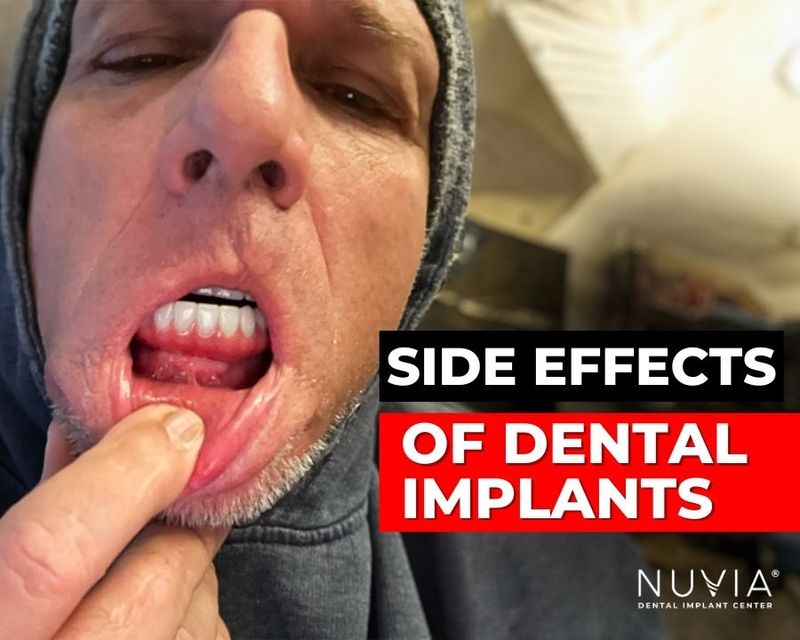 Patient’s Unfiltered Review of the Side Effects of Dental Implants