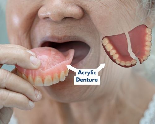 Acrylic Dentures are NOT Your Only Solution to Missing Teeth