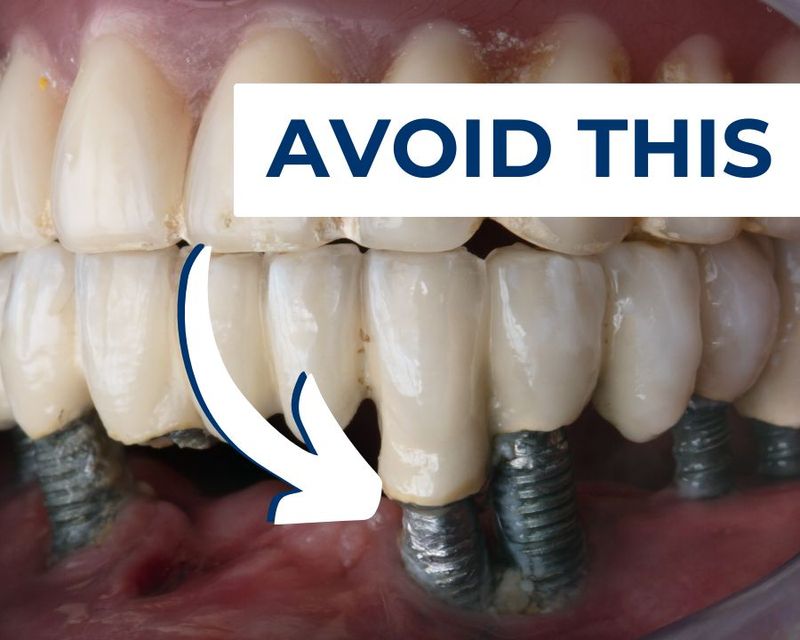 Bad Dental Implants: Causes, Signs, and What to Do