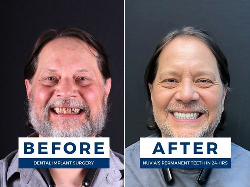 Your Guide to Zirconia Teeth and How to Get Them in 24 Hours