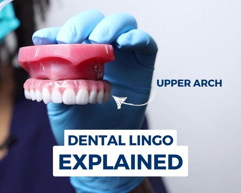 What is An Arch in Dental Implants?