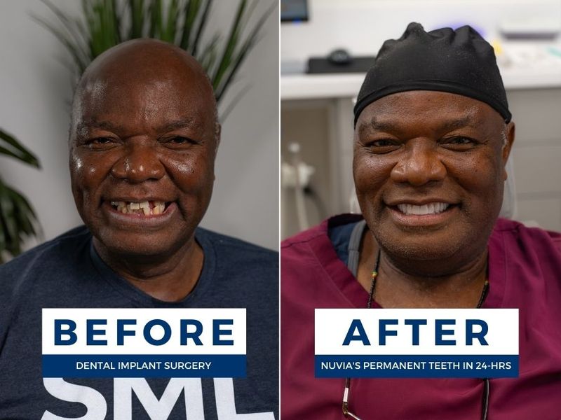 Your Guide to Zirconia Teeth and How to Get Them in 24 Hours