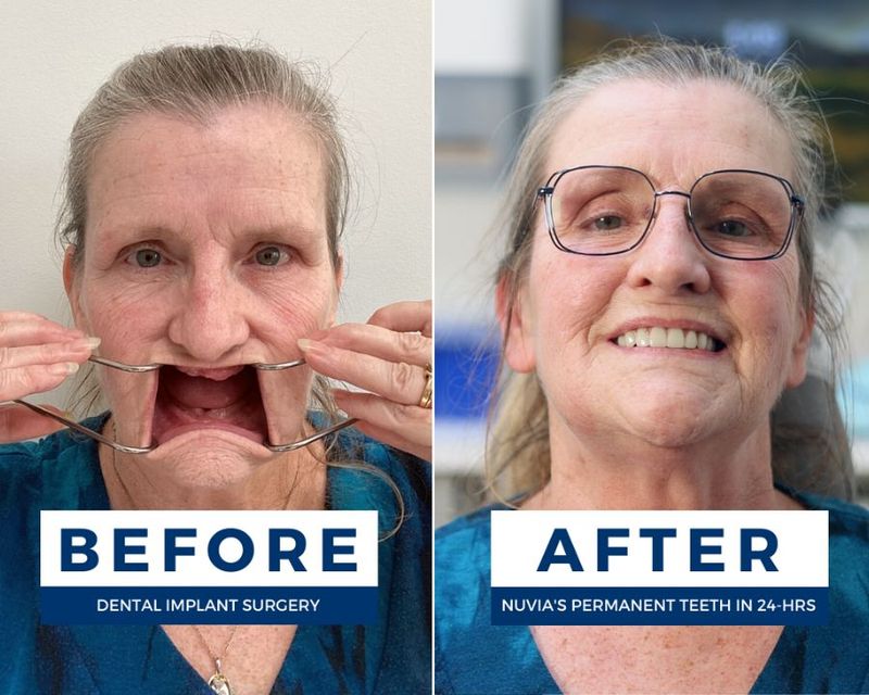 Are Dentures for Elderly People the Best Option? Pros and Cons