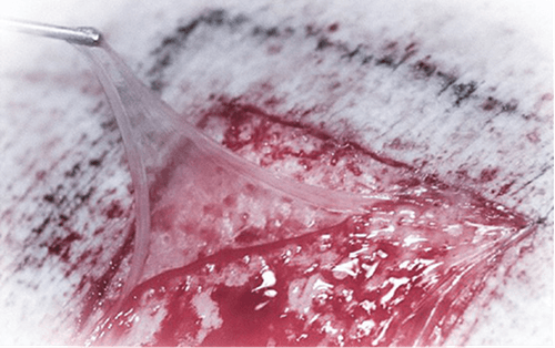 Tri-Membrane Wrap™ – Triple-Layer Amniotic Tissue Allograft