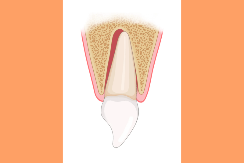 Extrusion: Findings, Treatment & Trauma Assessment Example