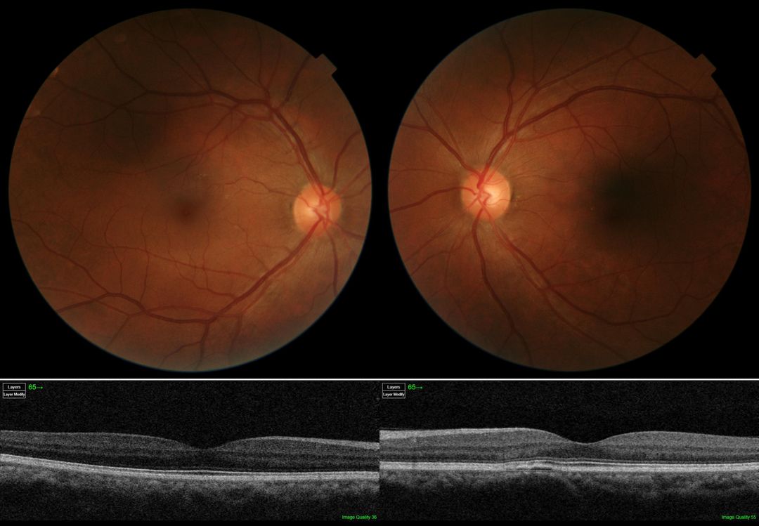 Patient With Past Retinal Fluid, Normal Vision Today