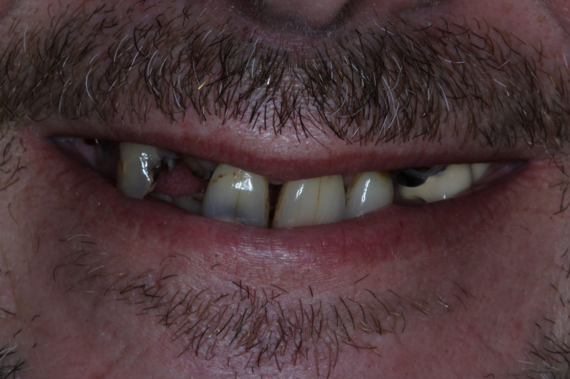 What are ‘wonky’ teeth? – Carisbrook Dental