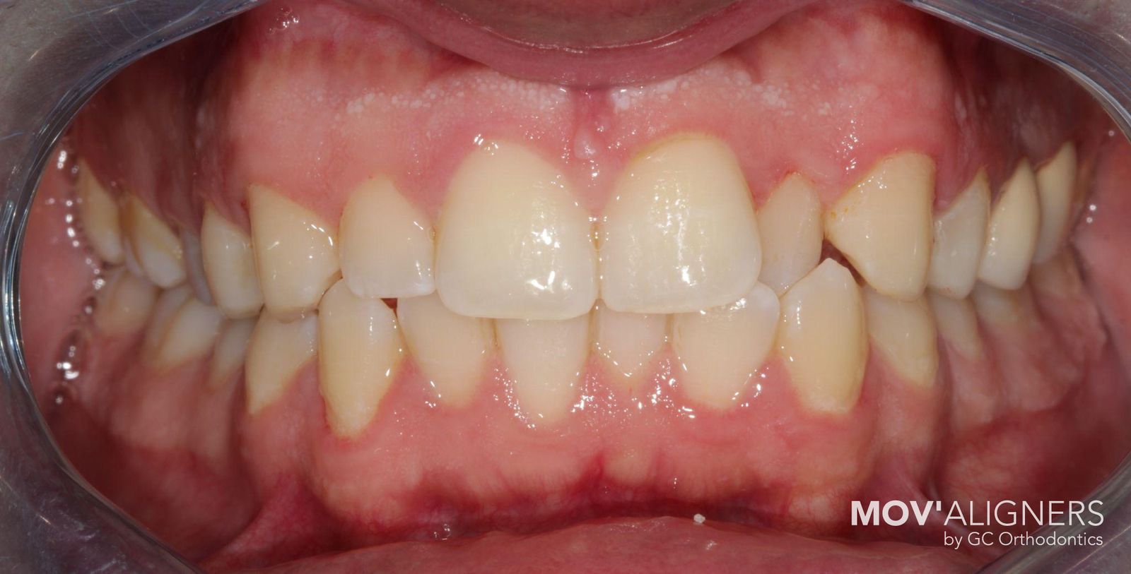 MOV’Aligners The Smile Designer