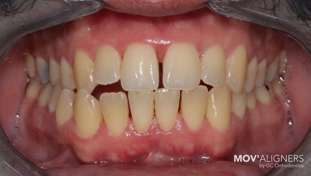 MOV’Aligners The Smile Designer