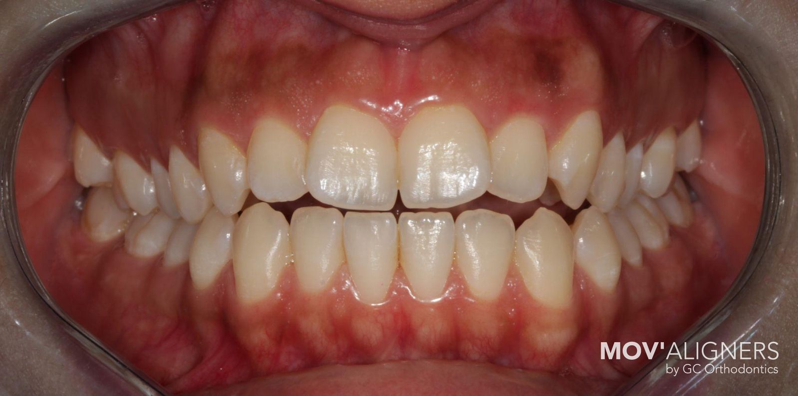 MOV’Aligners The Smile Designer