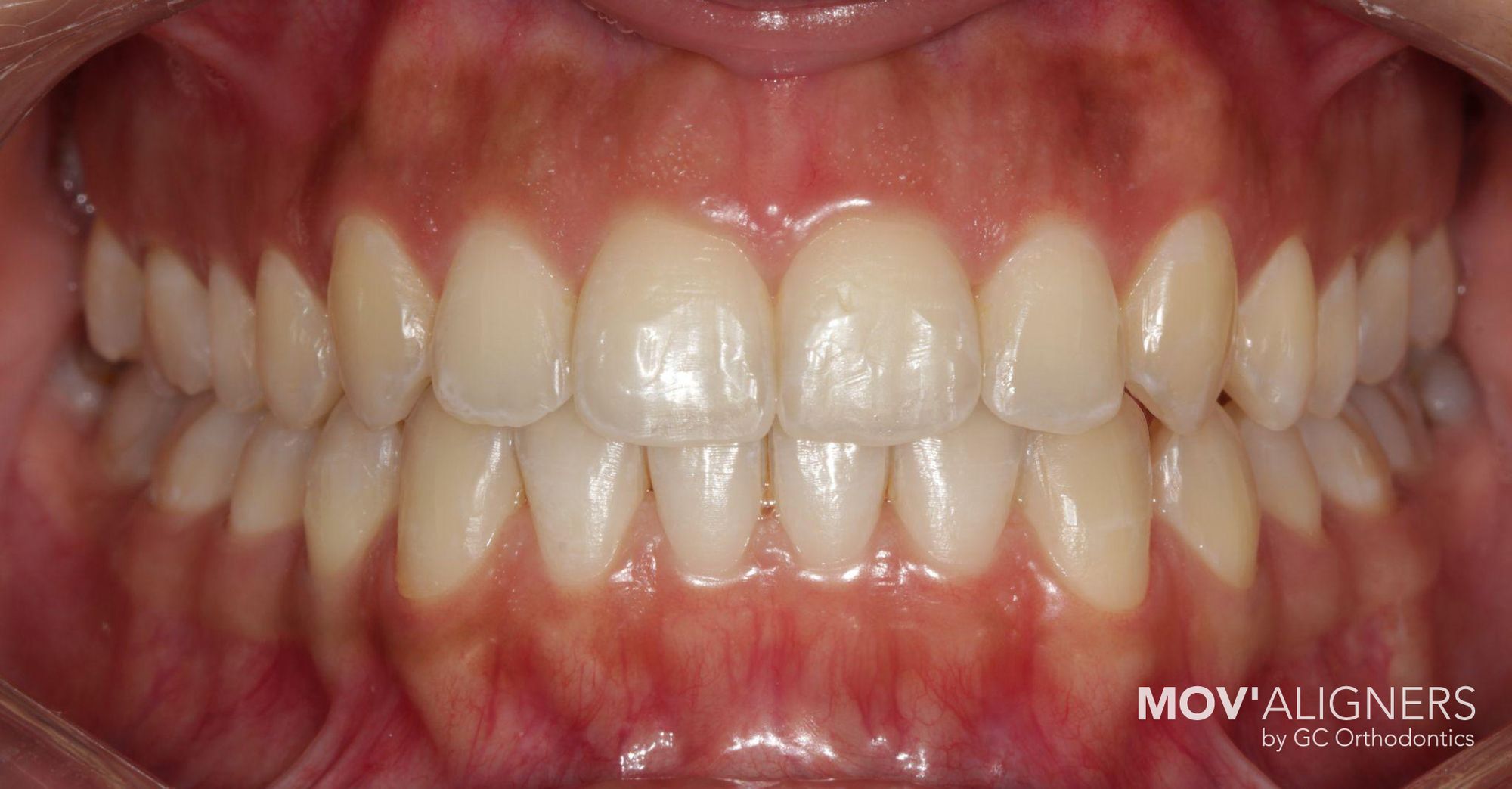 MOV’Aligners The Smile Designer