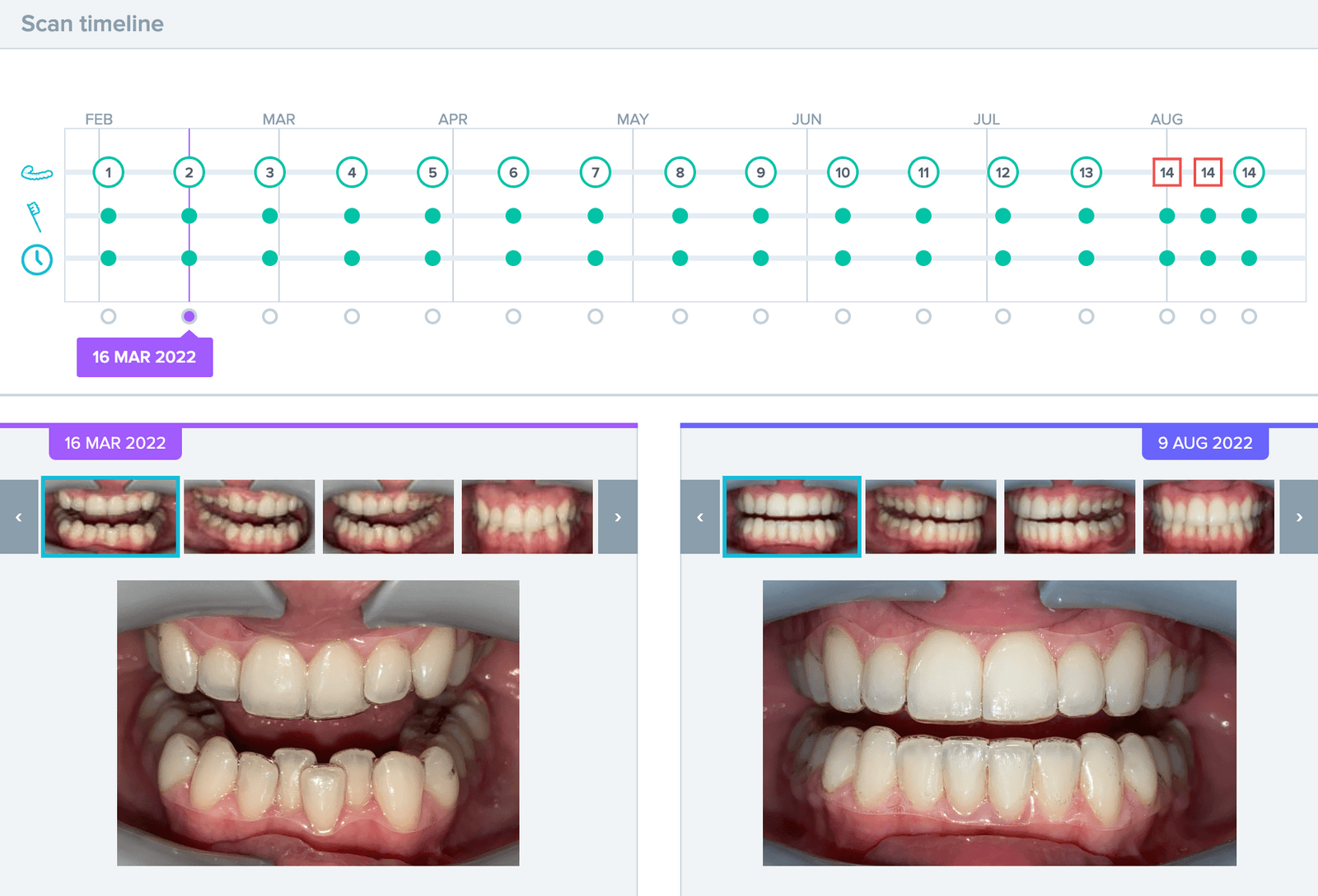 ProMonitoring - Powerful Remote Clear Aligner Monitoring