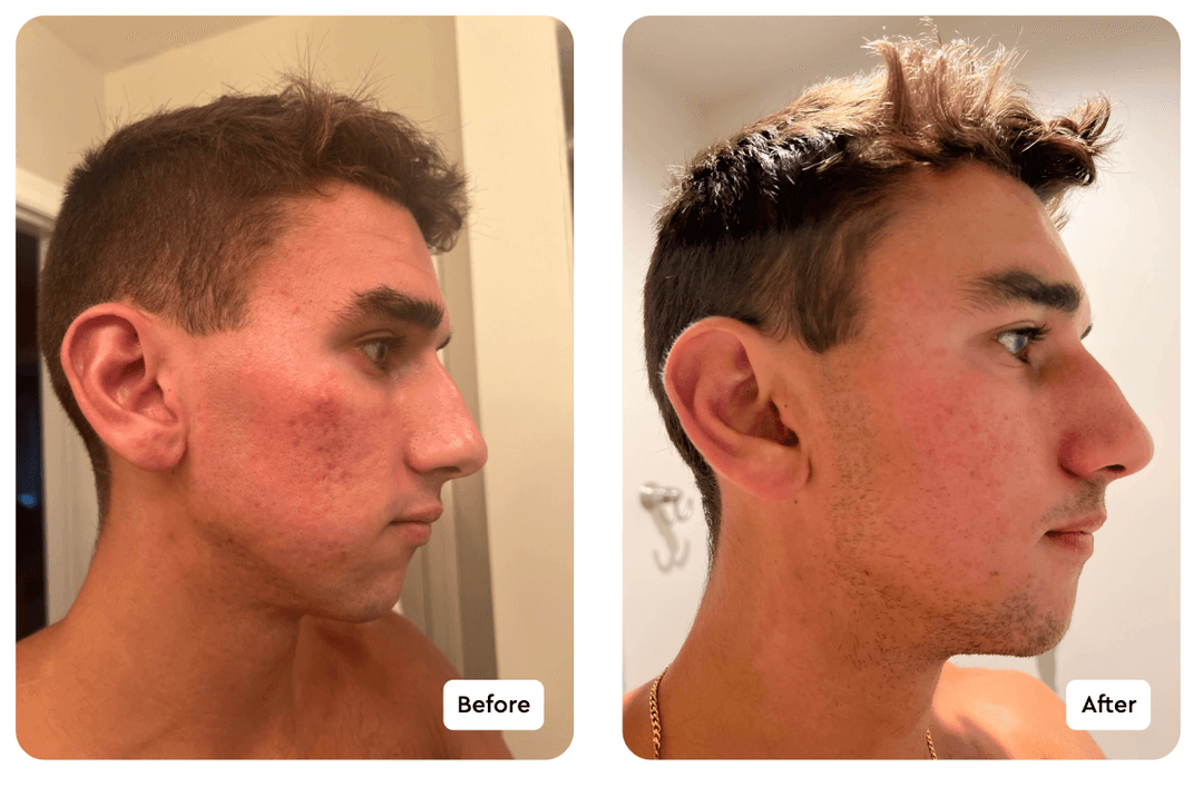 Accutane Prescribed Online | Honeydew