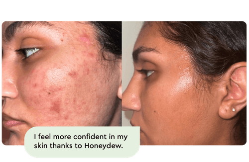 Accutane Prescribed Online | Honeydew