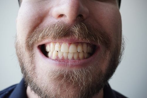 Ortodoncia Invisible Moons - Dientes Alineados sin Brackets