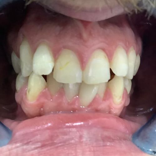 Ortodoncia Invisible Moons - Dientes Alineados sin Brackets