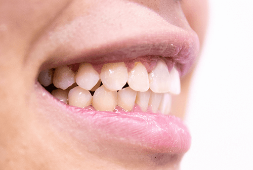 Ortodoncia Invisible Moons - Dientes Alineados sin Brackets