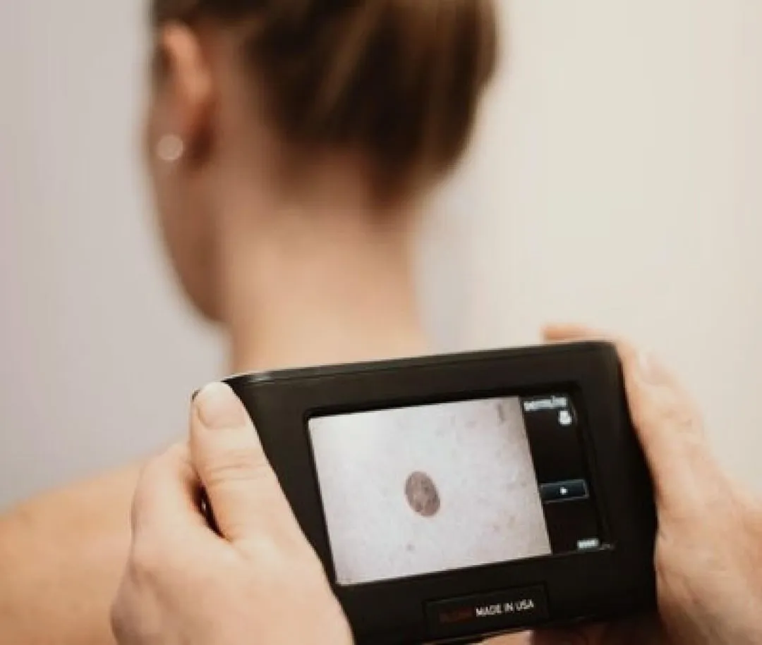 MoleMap New Zealand: Expert Skin Cancer Detection and Care