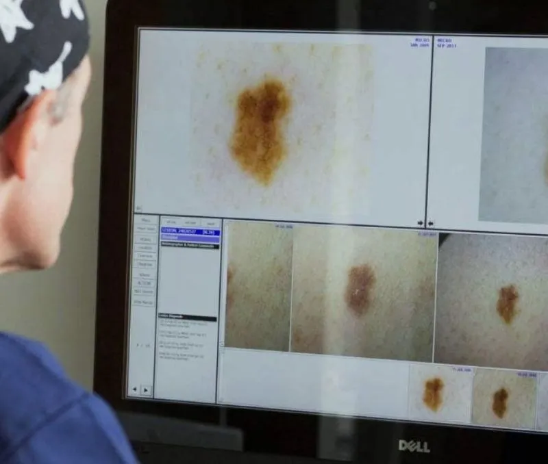 Full Body MoleMap. Book Your Mole Check At MoleMap NZ