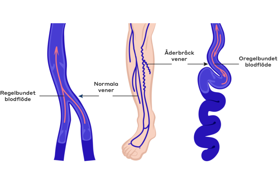 Åderbråck och dålig blodcirkulation - Åderbråcksklinikerna