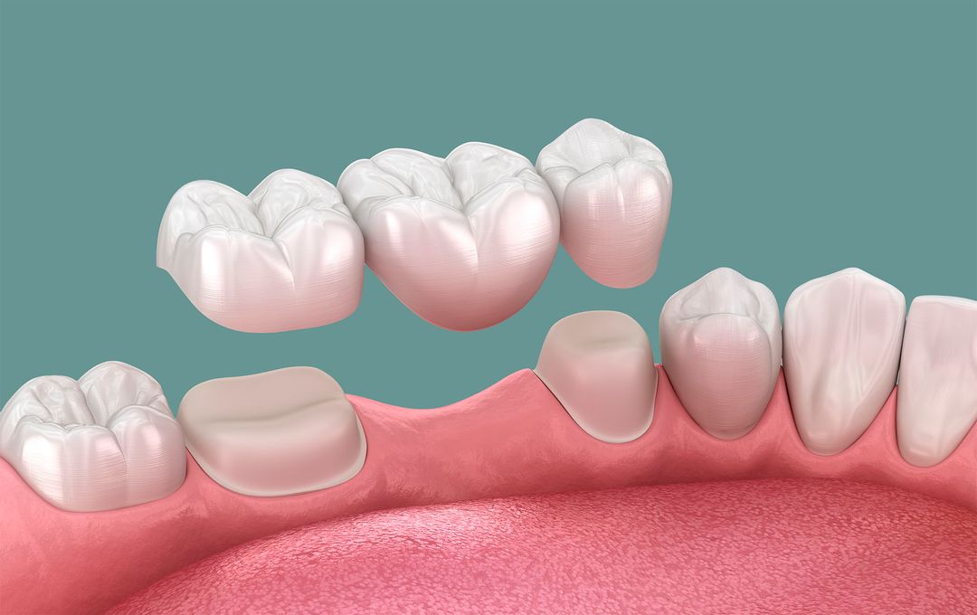Porcelain Dental Bridges in Winnipeg | Cholakis Dental Group