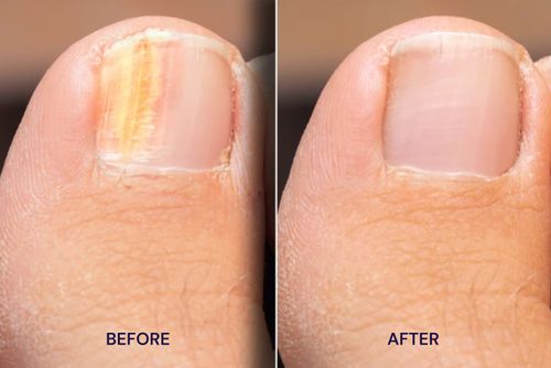 Prescription Toenail Fungus Treatment Online | STRIDE DUO™