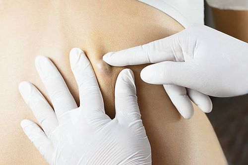 Cyst Removal in Northern Colorado | Altitude Dermatology