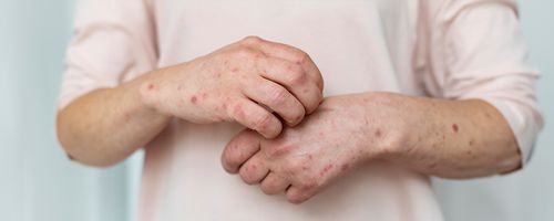 Papular Eczema: Causes, Symptoms, Treatment & Types of Eczema