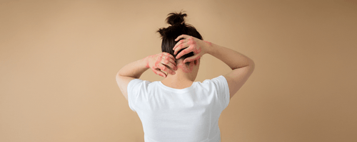 Weeping Eczema: Symptoms, Causes, and How to Treat It