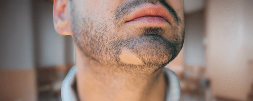 Alopecia Barbae: Causes, Symptoms, and Treatment Options