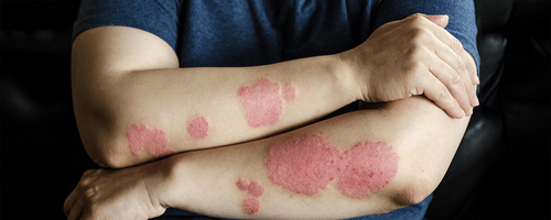 Know about Spongiotic Dermatitis: Itchy Patches of Skin