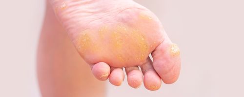 What is Plantar Hyperkeratosis? Symptoms, Causes & Diagnosis