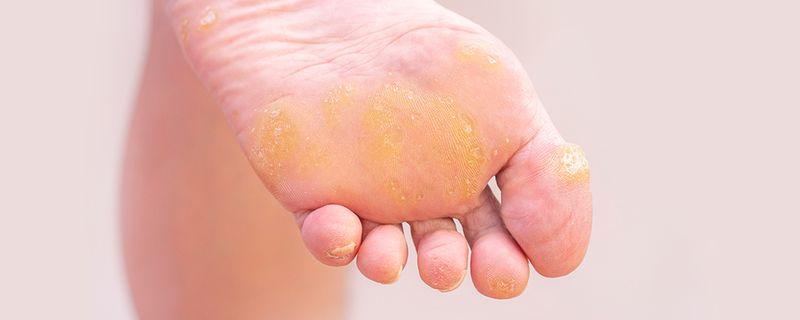 What is Plantar Hyperkeratosis? Symptoms, Causes & Diagnosis