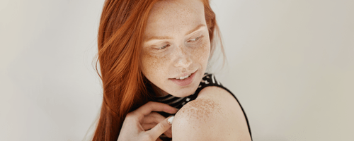 White Sun Spots on Skin: Signs, Causes & Possible Treatments