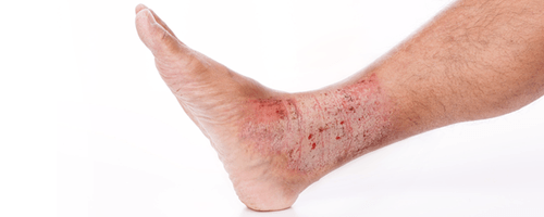 Lichen Simplex Chronicus (Neurodermatitis): Key Facts & Care