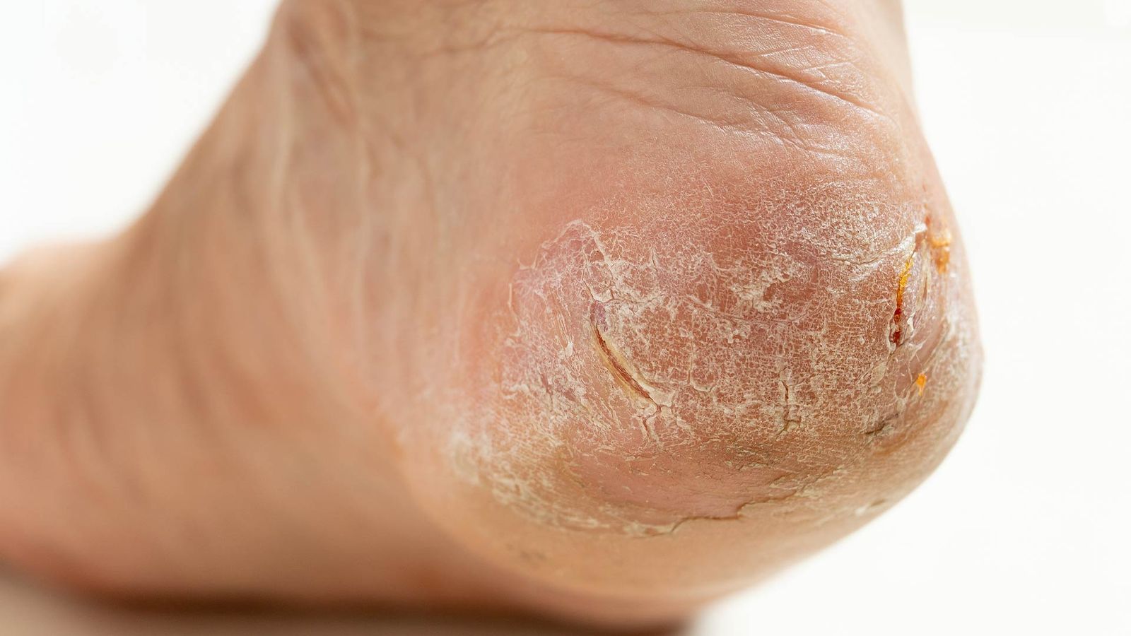 What is Keratoderma Blennorrhagicum: Thickened Skin Disorder
