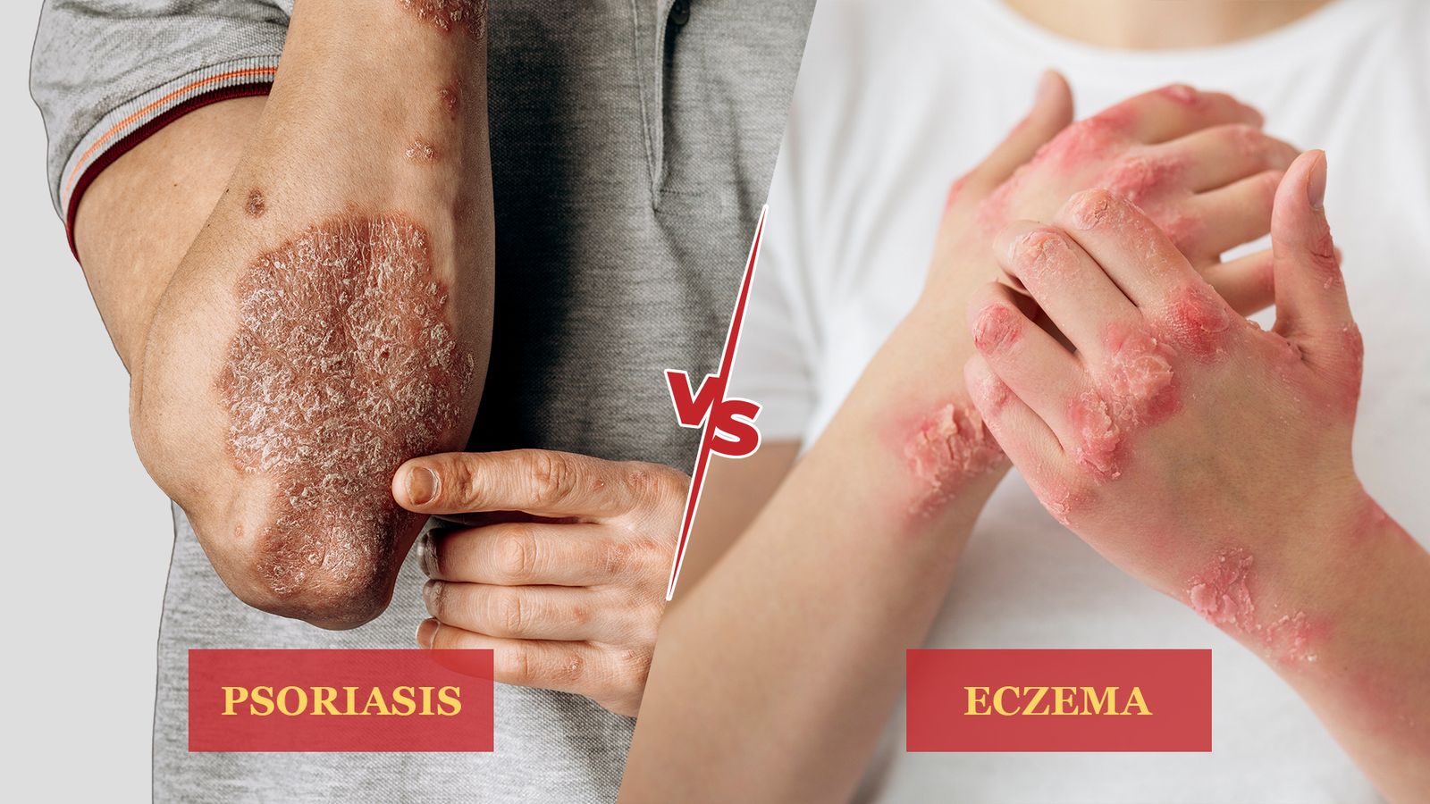 Psoriasis vs Eczema: Key Differences, Symptoms & Treatment