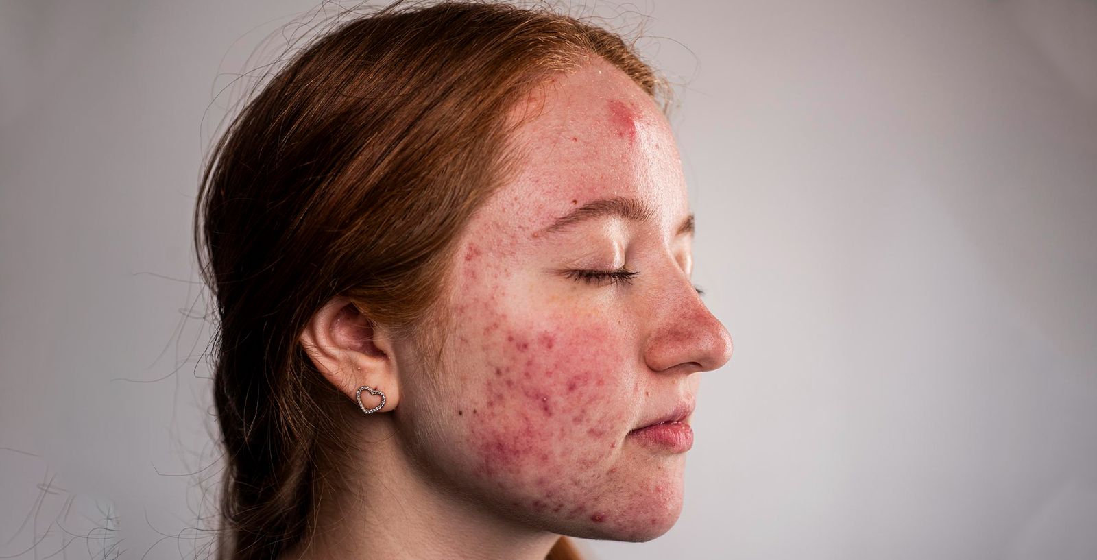 Cutaneous Lupus: Symptoms, Causes & Treatment Guide