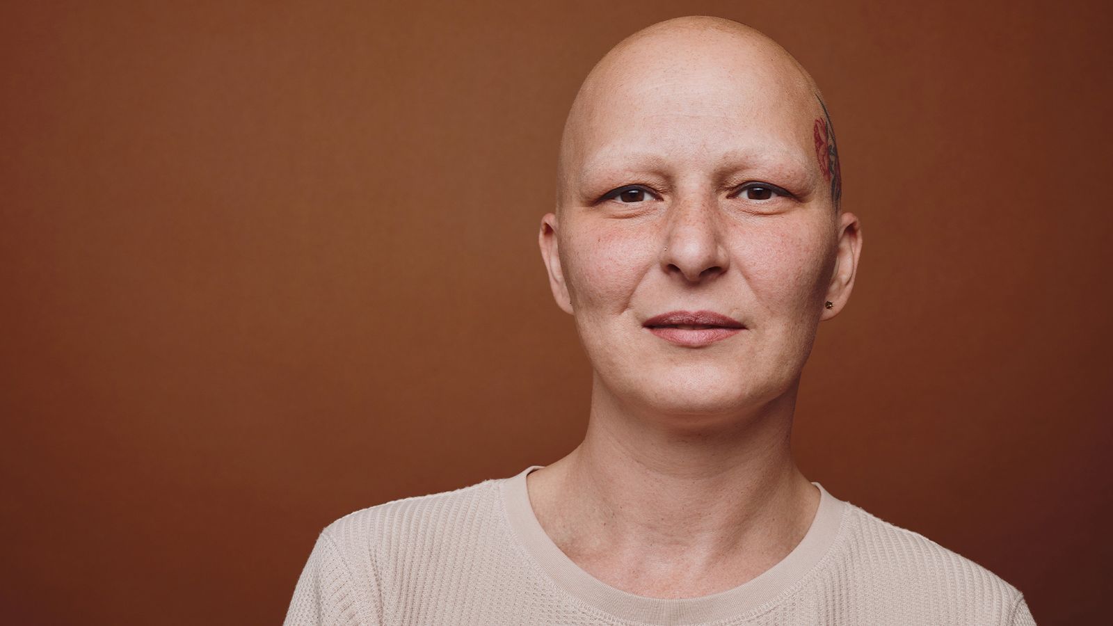 Alopecia Totalis: Causes, Symptoms and Treatment