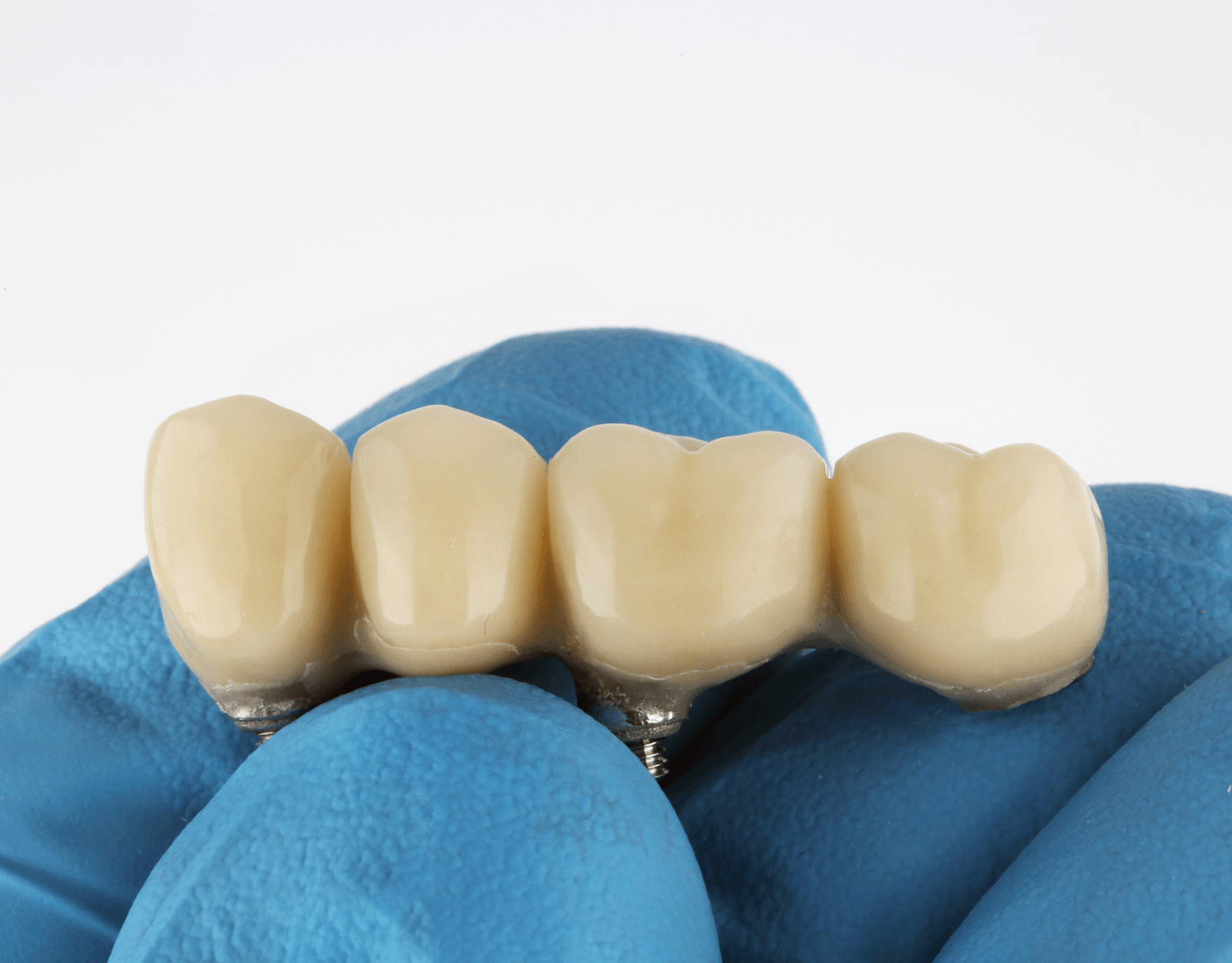 Los Pros y Contras de los Diferentes Tipos de Puentes Dentales: Una ...