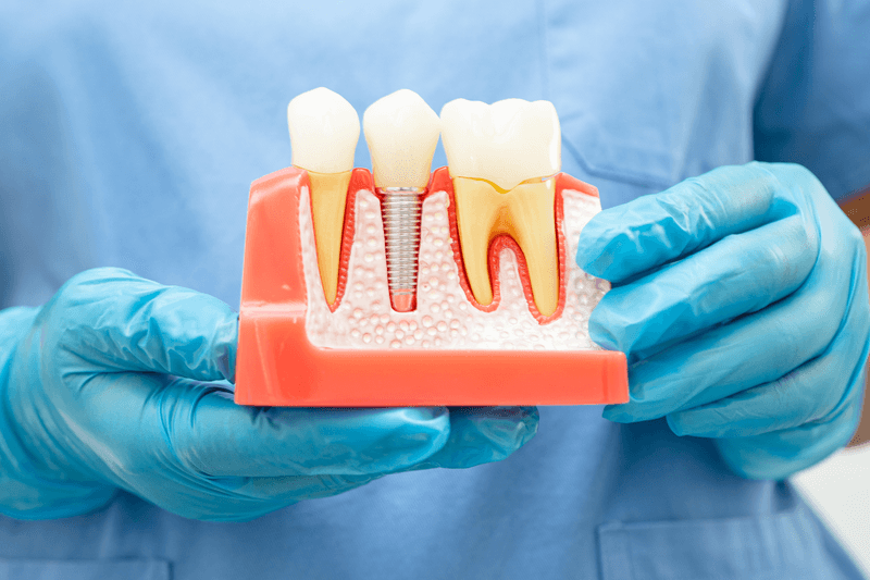 The Complete Guide to Tooth Restoration
