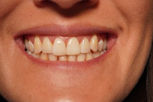 Ortodoncia invisible en Colombia: Dientes alineados sin brackets