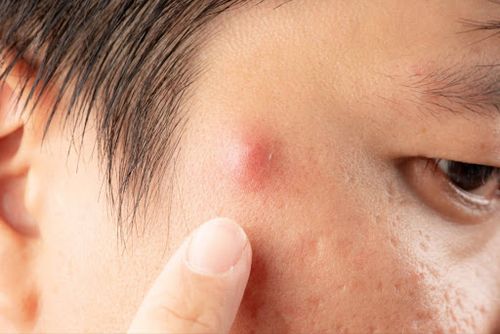 The 7 Stages of Healing: Cystic Acne | Piction Health