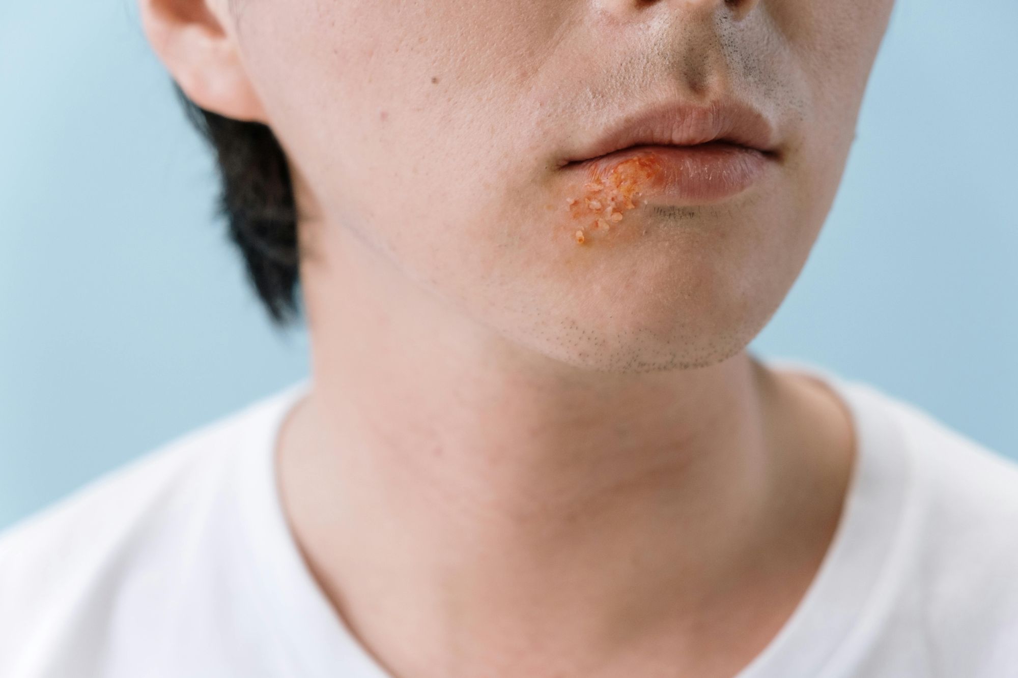 How Long Does Impetigo Last?