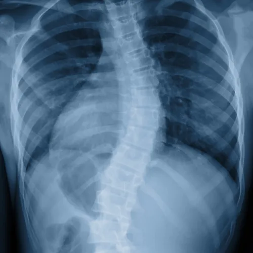 Spine Stabilization Surgery Explained: A Complete Guide for Patients