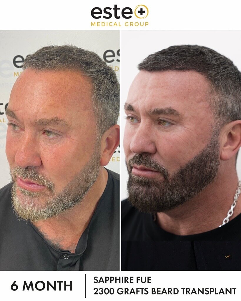 Beard Transplant | Este Medical Group